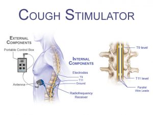Restoration of Cough - Cleveland FES Center