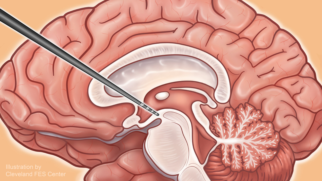 Novel STN Patterns – Parkinson’s Disease - Cleveland FES Center