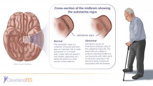 Parkinson’s - Cleveland FES Center